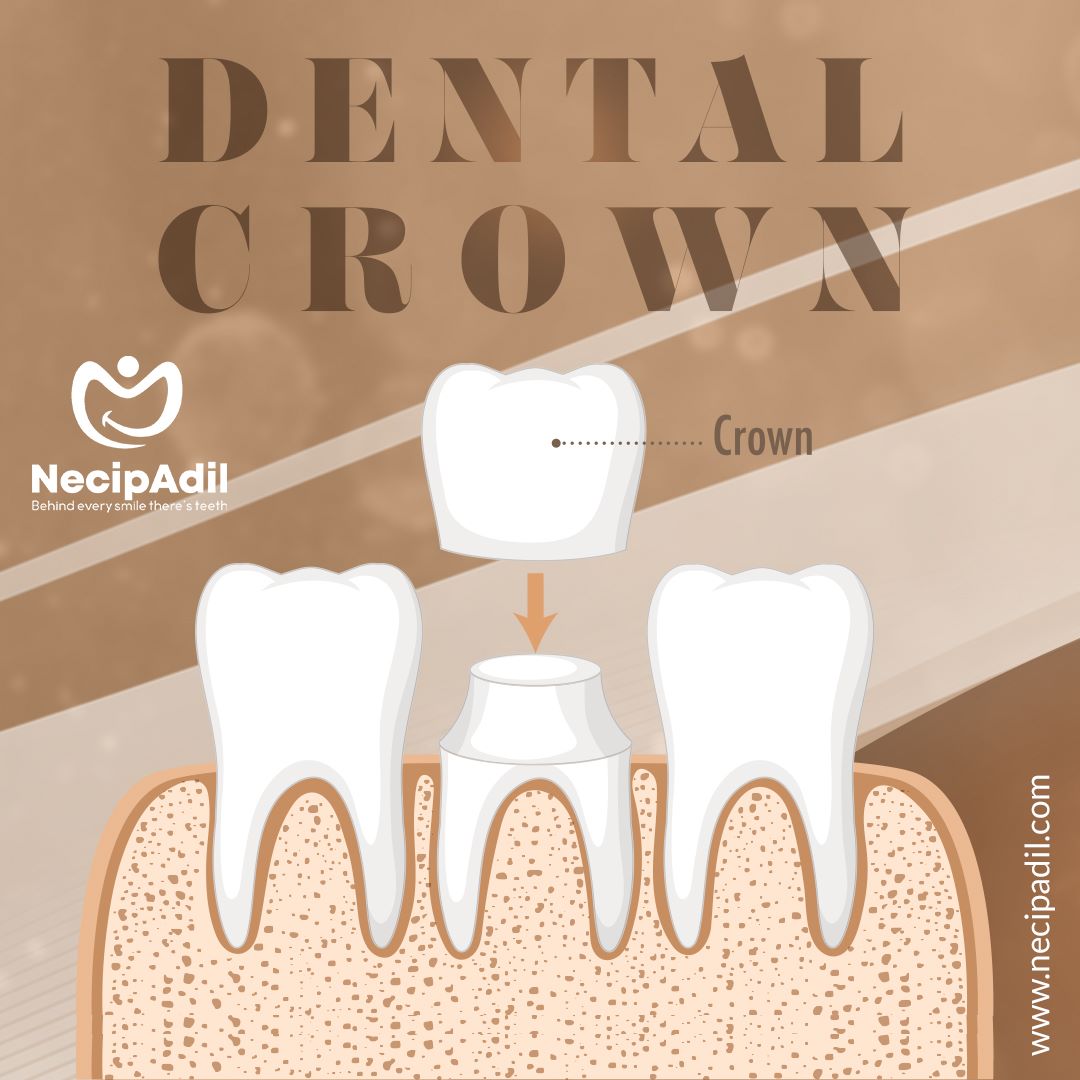 Everything You Need to Know About Getting a Dental Crown - Dr.Necip Adil